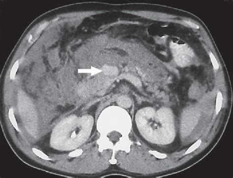 Figure 1 From Percutaneous Thrombin Embolization Of A Ruptured Peripancreatic Pseudoaneurysm