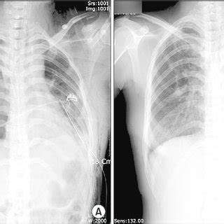 Chest X Ray Findings A The Initial Chest X Ray Taken At The Emer Download Scientific Diagram