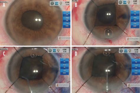 Diffuse Lamellar Keratitis