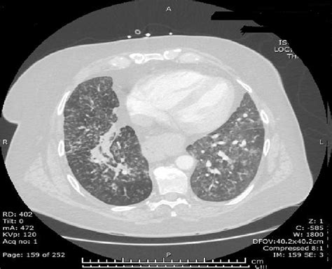 Ct Lung Windows Diffuse Bilateral Interstitial Infiltrates With Tree Download Scientific