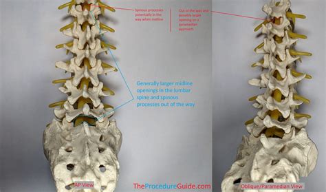 Fluoroscopic Guided Thoracic Lumbar Interlaminar Epidural Steroid Injection Technique And