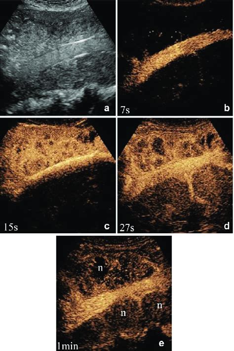 Attenuation Caused By Too Much Microbubble Contrast Agent A This Download Scientific Diagram