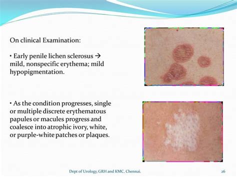 Penis Balanitis Xerotica Oblitarans Bxo Pdf
