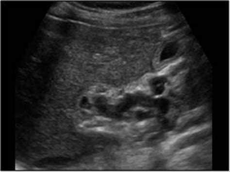 Abdomen And Retroperitoneum 11 Liver Case 1113 Hepatic And