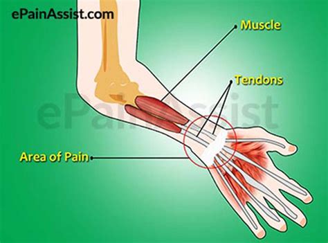 What Causes Tendonitis Shoulder Impingement Rotator Cuff Tendinitis
