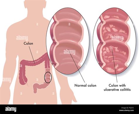 Chronic Ulcerative Colitis Stock Vector Images Alamy