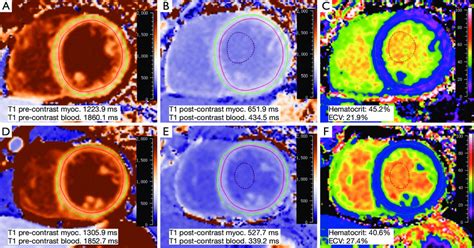 The T1 Mapping Method T1 Mapping Of A Severe Osa Patient A C And A Download Scientific