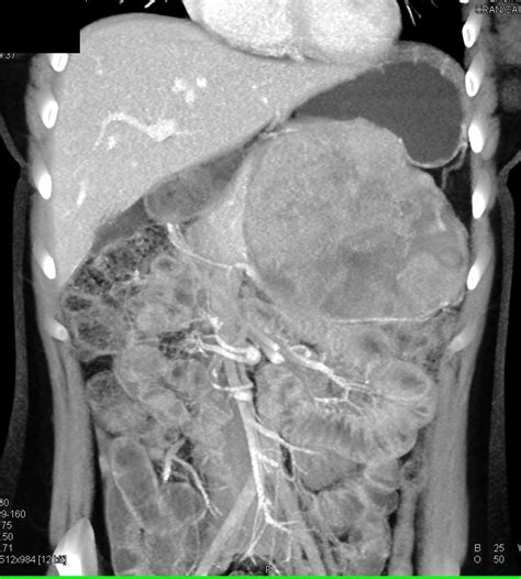 Gastric Gist Tumor Stomach Case Studies Ctisus Ct Scanning