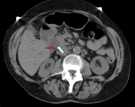Common Pathology With Atypical Presentation Acute Cholangitis Pmc