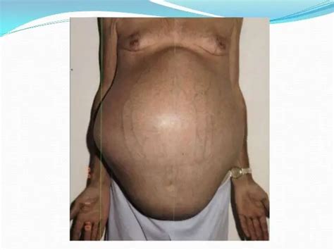 Abdomen En Batracio Un Signo De Ascitis Crónica Doctor Online