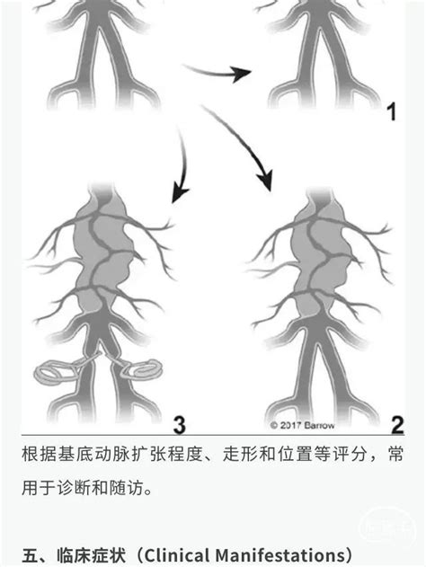 椎基底动脉冗长扩张综合征（vertebrobasilar Dolichoectasia Vbd） 脑医汇