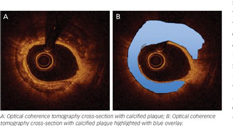 Figure 1 From Lesion Preparation With Orbital Atherectomy Semantic Scholar