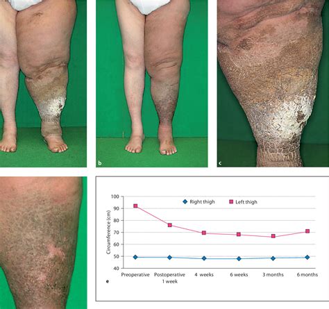 Treatment Of Elephantiasis Nostras Verrucosa With Co2 Laser 55 Off