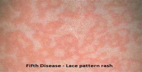 Fifth Disease Health