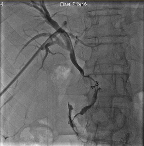 Percutaneous Transhepatic Cholangiography Pacs