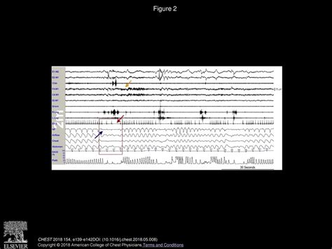A Year Old Athletic Man With Bradycardia During Sleep Ppt Download
