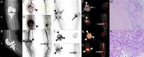 True Positive Findings In Three Phase Bone Scan And Positron Emission