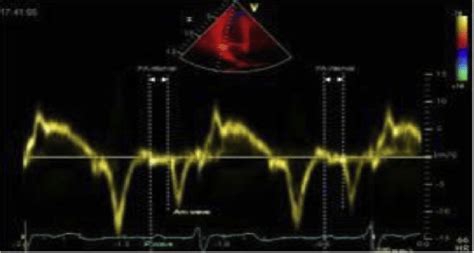 Measurement Of Interatrial Conduction Time Pp 138 Download Scientific Diagram