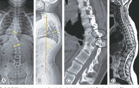 Figure 7 From Validation Of Rajasekarans Kyphosis Classification Semantic Scholar
