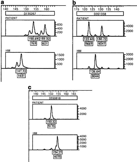Microsatellite Polymorphisms Of The Patient And The Diploid