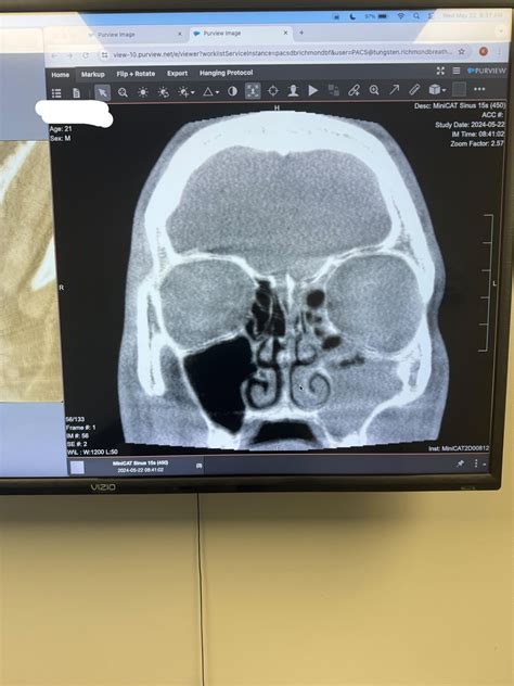 Sinus Surgery Questions Rsinusitis