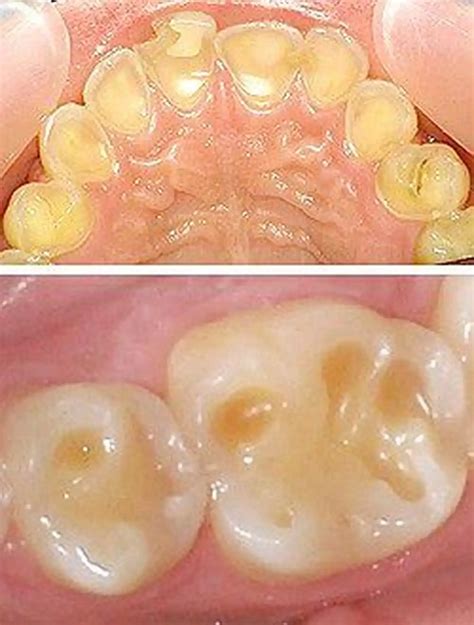 Erosion Teeth