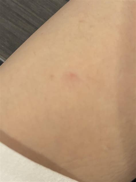 Does This Look Like A Positive Ppd Test Rmedical