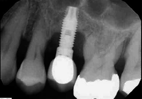 Loss Of Interproximal Contacts Resulting In Food Trap And Peri‐implant Download Scientific