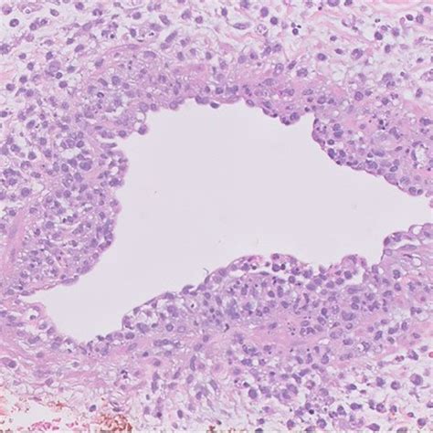 Case 1 Biopsy Of Lesion Showed Medium Vessel Vasculitis With A