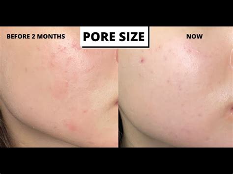 My Treatment For Open Skin Pores On Face Glowpink