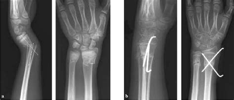 Figure From Distal Radius Fractures Nonoperative And Percutaneous My XXX Hot Girl