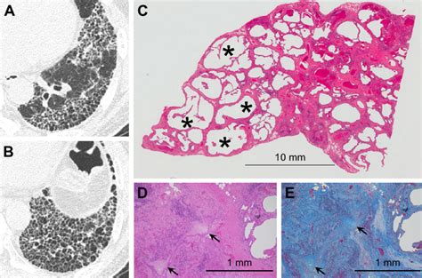 Uip Pattern On Thin Section Ct Images And Histological Findings Notes Download Scientific