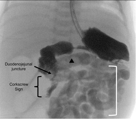 Green Amniotic Fluid In A Term Neonate Consultant360
