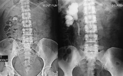 Scout Film And Delayed Films Of Intravenous Pyelography Showing Right Download Scientific