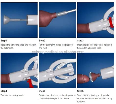 Top Quality Medical Surgical Instruments Disposable Skin Circumcision ...