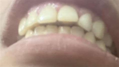 Can I Get Invisalign With Short Root Rinvisalign