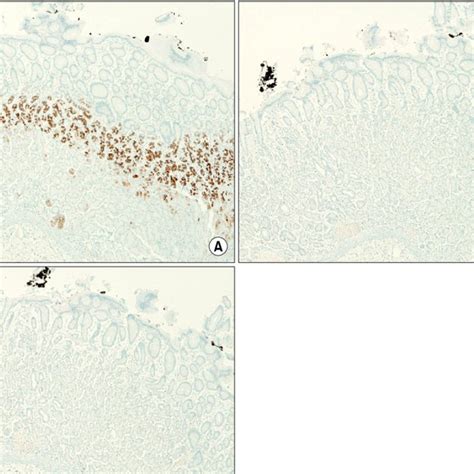 Pdf Oxyntic Gland Adenoma Treated By Endoscopic Mucosal Resection