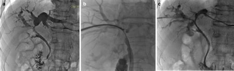 Hilar Cholangiocarcinoma Bismuth Type Iv In A 62 Year Old Woman A
