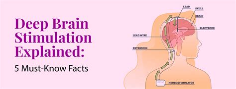Deep Brain Stimulation Explained: 5 Must-Know Facts