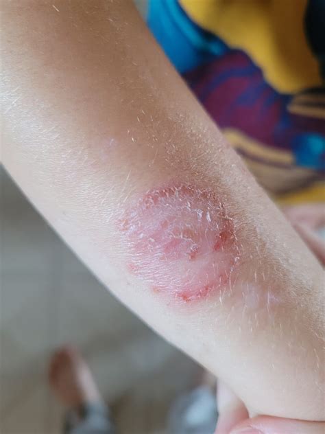 What Is Wild Parsnip How To Treat Wild Parsnip Rash Donvey Farms What Is Wild Parsnip How To Treat Wild Parsnip Rash Donvey Farms