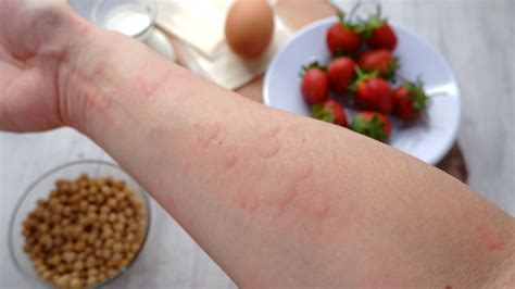 Innovations In Allergen Detection Technologies Impacts And Solutions