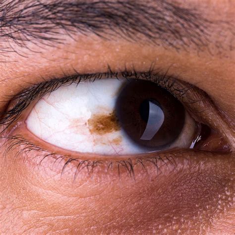 Ocular Melanoma Keep An Eye On Common Risk Factors For Ocular Melanoma
