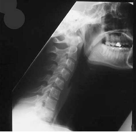 Lateral Cervical Spine X Ray Showing Loss Of Normal Cervical Lordosis My Xxx Hot Girl