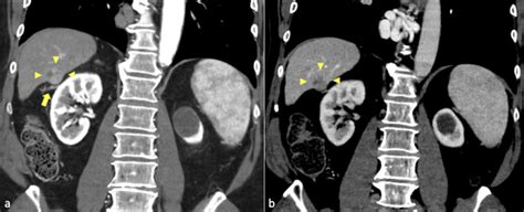Ceus Speeds Up Cancer Treatment For Teacher With Liver Tumor International Contrast Ultrasound