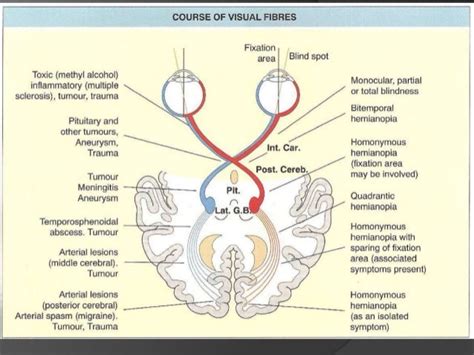 Small Optic Nerve