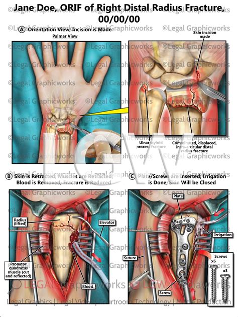 Orif Of Right Distal Radius Fracture Lgwgo
