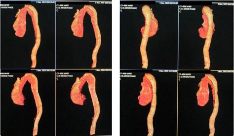 3d Reconstruction Showed An Intimal Dissecting Flap Starts From Download Scientific Diagram
