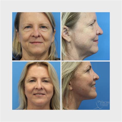 Before And After Gallery Facial Surgery Center Charleston