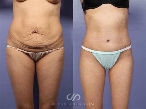 Tummy Tuck Transformation Before And After Results Before After