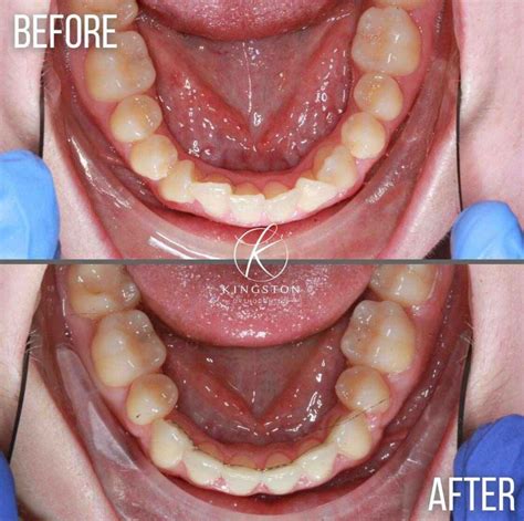 Underbite Causes And Treatment Option